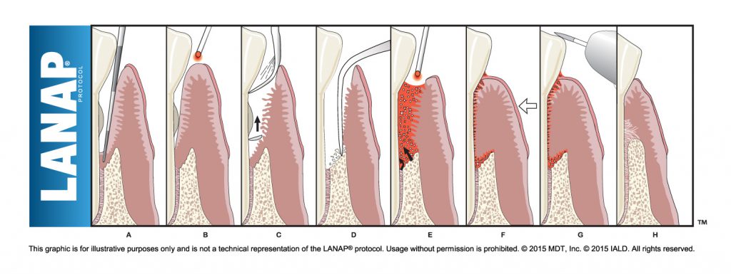 Gum Disease Laser Therapy San Leandro CA